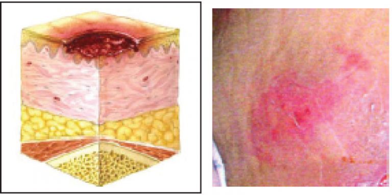 Clasificación - Ulceras Chile